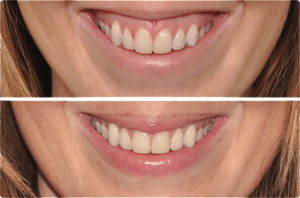 Gummy Smiles | Orthodontist Gaithersburg MD Invisalign | Yu Orthodontics